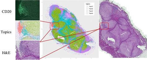 1303 Spatial Topic Modeling Of Tumor Microenvironment With Multiplexed Imaging Journal For