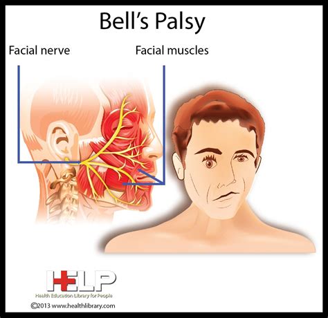 Cranial Nerve 7 Bell S Palsy Causes
