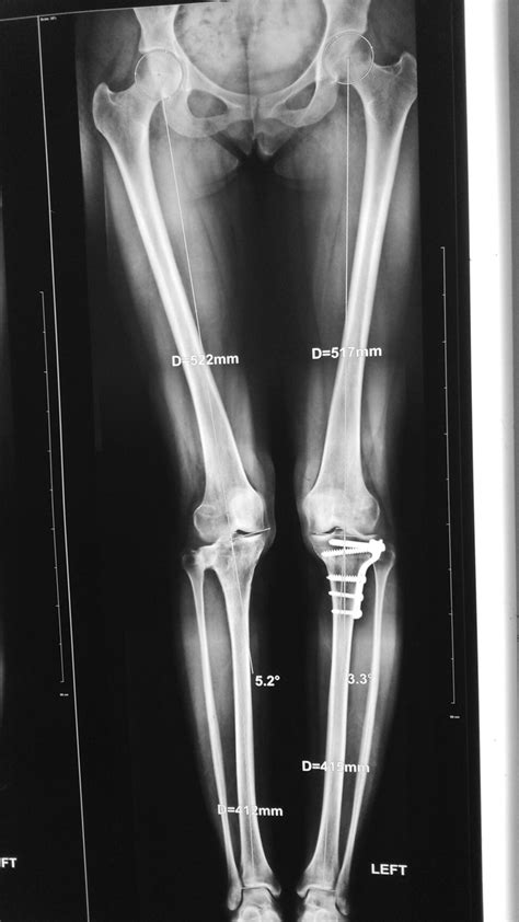 Twenty Three Year Old Female 2 Years After Closing Wedge High Tibial