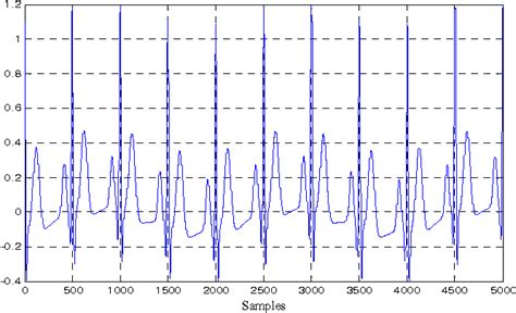 figure 2 from svd based method for ecg denoising semantic scholar