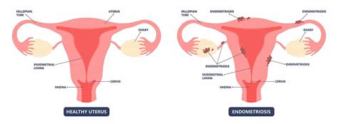 Endometriosis Symptoms Treatments Fertility Los Angeles