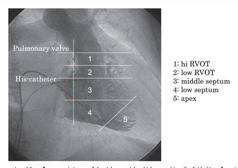 Figure 3 From Effect Of Right Ventricular Pacing Site On Qrs Width Semantic Scholar