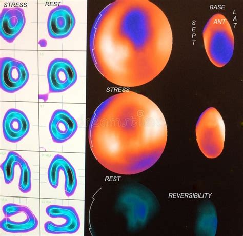 Myocardial Ischemia Nuclear Medicine Stock Image Image Of Mild Artery 30933647