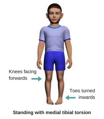 Pigeon Toes Causes And How Exercises Can Help To Improve Intoeing Gait