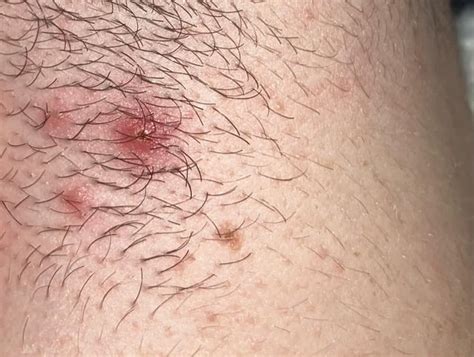 Nodules In Post Scabies R Scabies