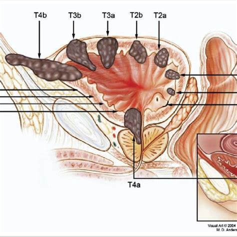 Cystoscopic Image Of Polypoid Urinary Bladder Tumor Image Courtesy Of Download Scientific