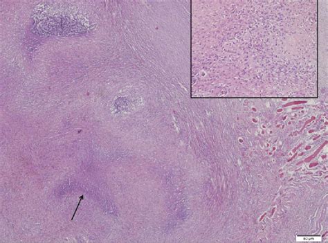 Rheumatoid Nodule Nodular Lesion Infiltrating The Striated Muscle Download Scientific Diagram