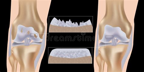 Illustration Osteoarthritis Stock Illustrations 4521 Illustration