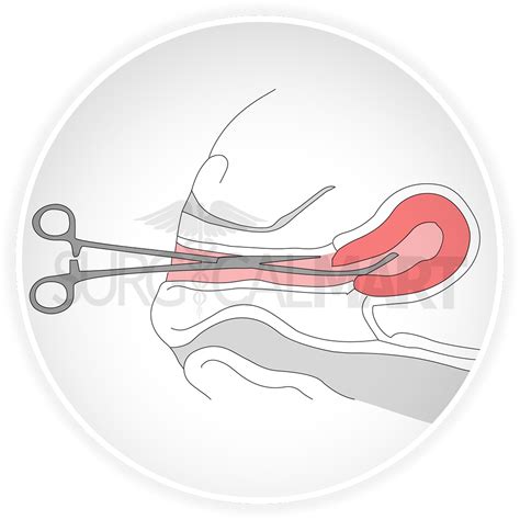 Hulka Controlling Tenaculum Uterine Forceps 11 Surgical Mart