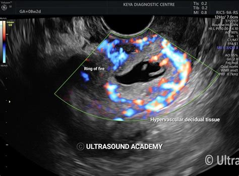 Cervical Ectopic Pregnancy Case By Dr Nitin Jadhav