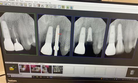 A New Smile In A Day Same Day Implant With Temporary Crown