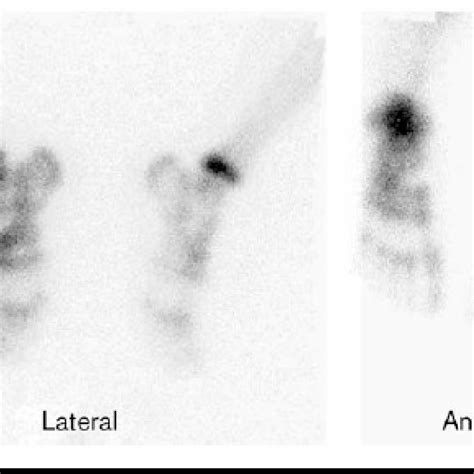 Pdf Osteomyelitis Clinical Update For Practical Guidelines