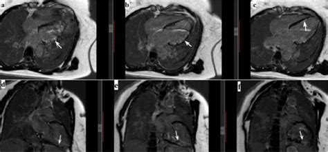 Cmr Diffuse Subendocardial Enhancement In Lge Images Regarding The