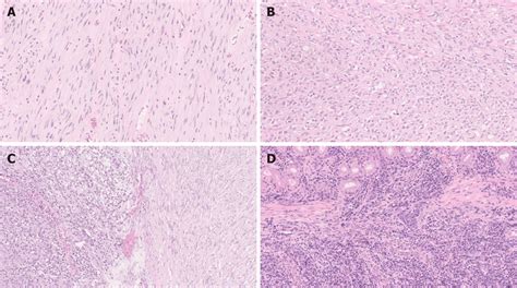 Gastrointestinal Stromal Tumor A Spindle Gastrointestinal Stromal Download Scientific Diagram