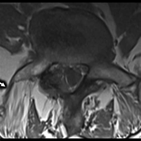 The Odriscoll Method For Classification Sagittal Ct Reconstruction Of