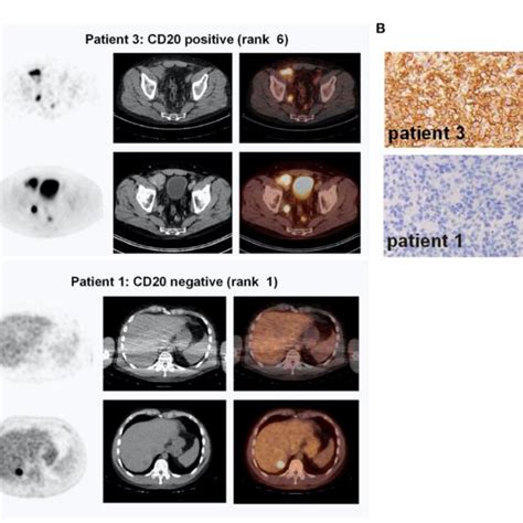 Astct Crs Consensus Grading Adapted From Lee Et Al Astct Bbmt 2019 75 Download Scientific