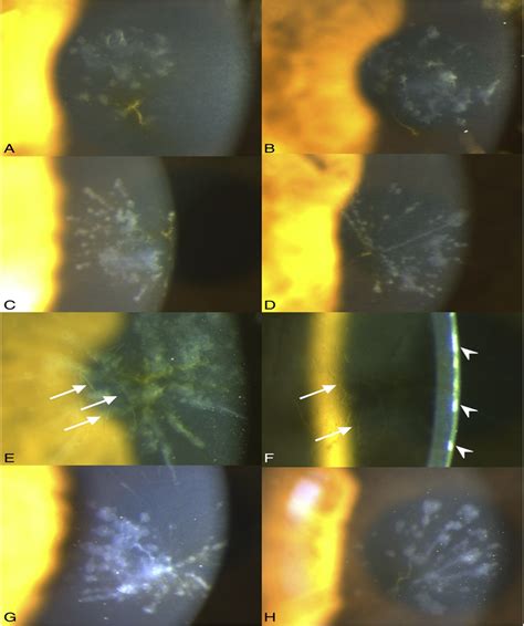 Novel Manifestation Of Corneal Dystrophy After Keratorefract Cornea