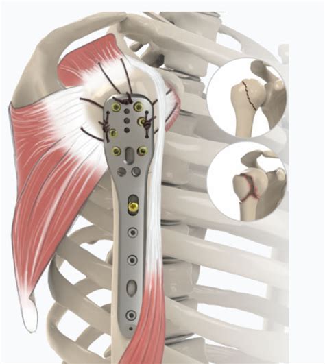 Компрессионная костная пластина плечевая кость 1832 Series Zimed Medical проксимальная