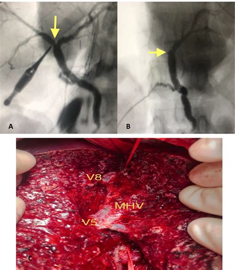A Precut Cholangiogram After Liver Transection With Bulldog Clamp