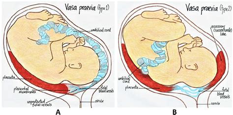 Placenta Previa Types 4