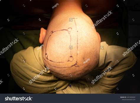1 Craniotomy Position Royalty Free Photos And Stock Images Shutterstock
