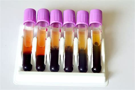 Blood Sample For BNP Test Stock Image Image Of Infarction