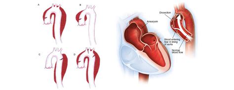 Aortic Dissection Surgery Clinic In Chennai Aortic Dissection Treatment Management In Chennai
