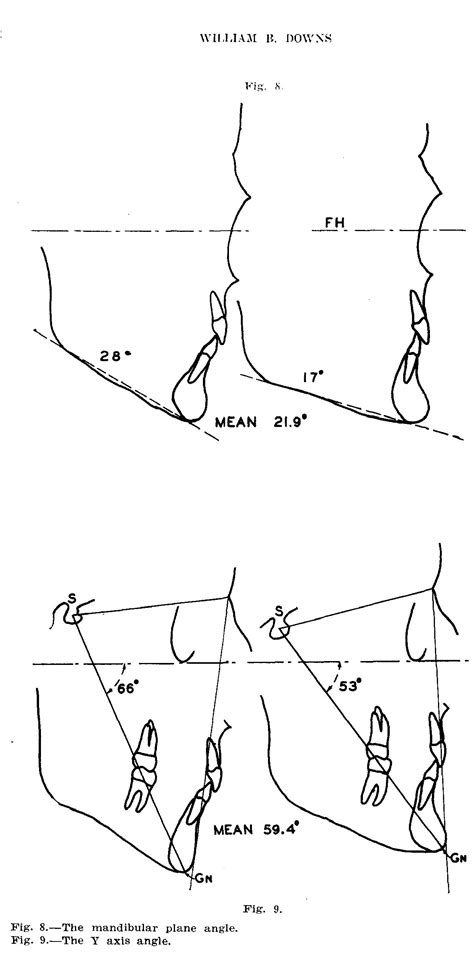 ‘ig 8—the Mandibular Plane Angle ‘ig 9—the Y Axis Angle