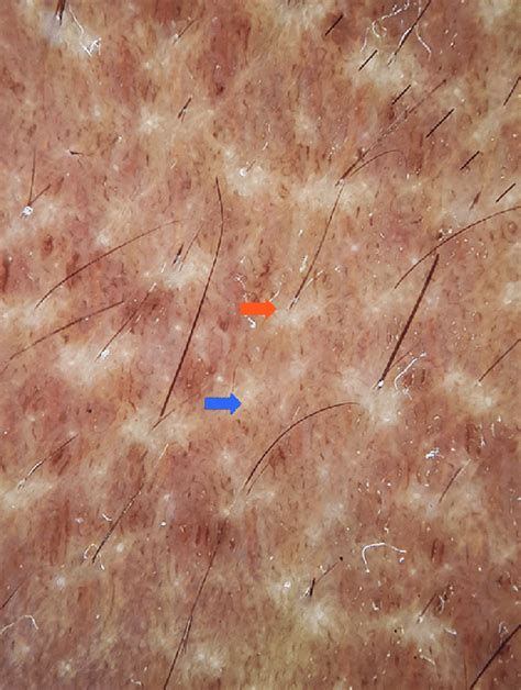 Dermoscopy Of Confluent And Reticulated Papillomatosis Shows Fine White
