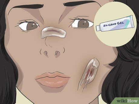 4 Easy Ways To Prevent Scarring On Your Face WikiHow