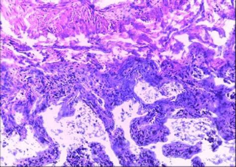 Reticulum Catarrhal Fibrinous Inflammation Of The Mucosa Edema Of The