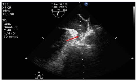 Left Atrial Appendage Laa Thrombus On Trans Oesophageal Download Scientific Diagram