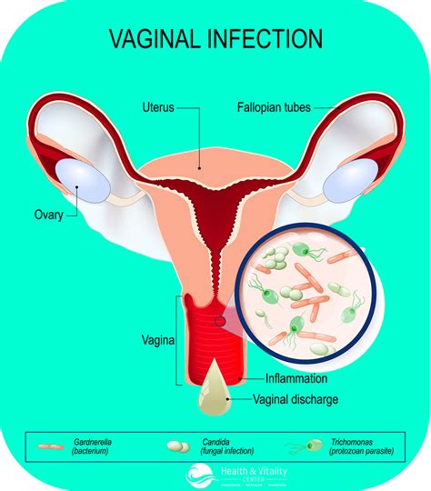 Vaginal Bacterial Infection Discharge