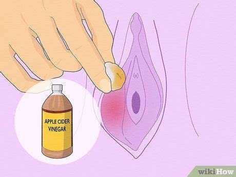 Female Genital Cysts