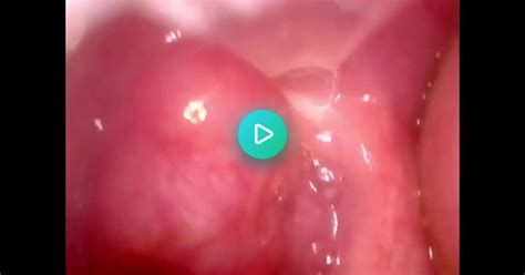 Pressing Out An Infected Tonsil  On Imgur