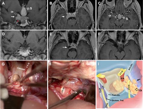 Frontiers Pituitary Adenoma With Cavernous Sinus Compartment