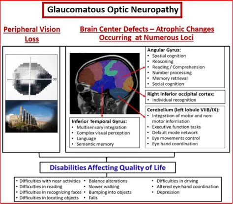 The Deleterious Effects Glaucomatous Optic Neuropathy Gon On Retinal