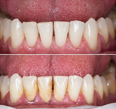 Calculus Bridge Causes Risks And Prevention Guide Spire Dental Care Langley