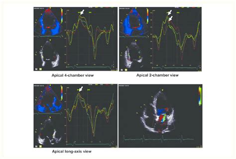 An Example Of Patient Without Significant Functional Mitral Download Scientific Diagram