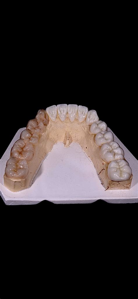 Plamen Vasilev On Linkedin Playing Wit Wax And Composite At Tusk Dental Technologies