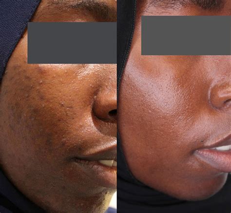 Treatment For Post Inflammatory Hyperpigmentation Cutis Clinic