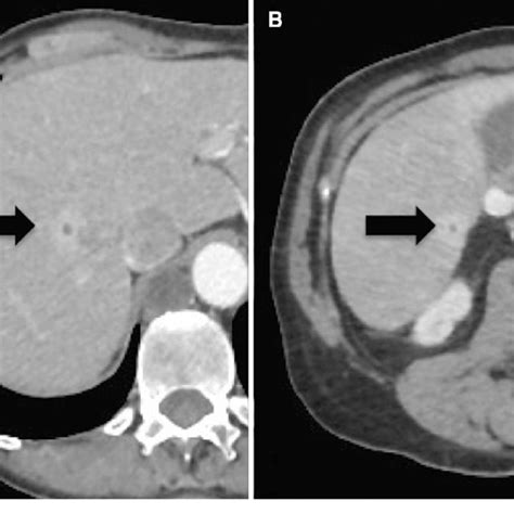 Ct Scan In Arterial Phase At 3 Weeks Post Embolization Confirmed Lack Download Scientific