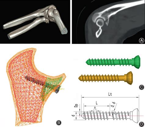 Ad Finite Element Fe Modeling Of Ulnar Coronoid Fracture Treated Download Scientific