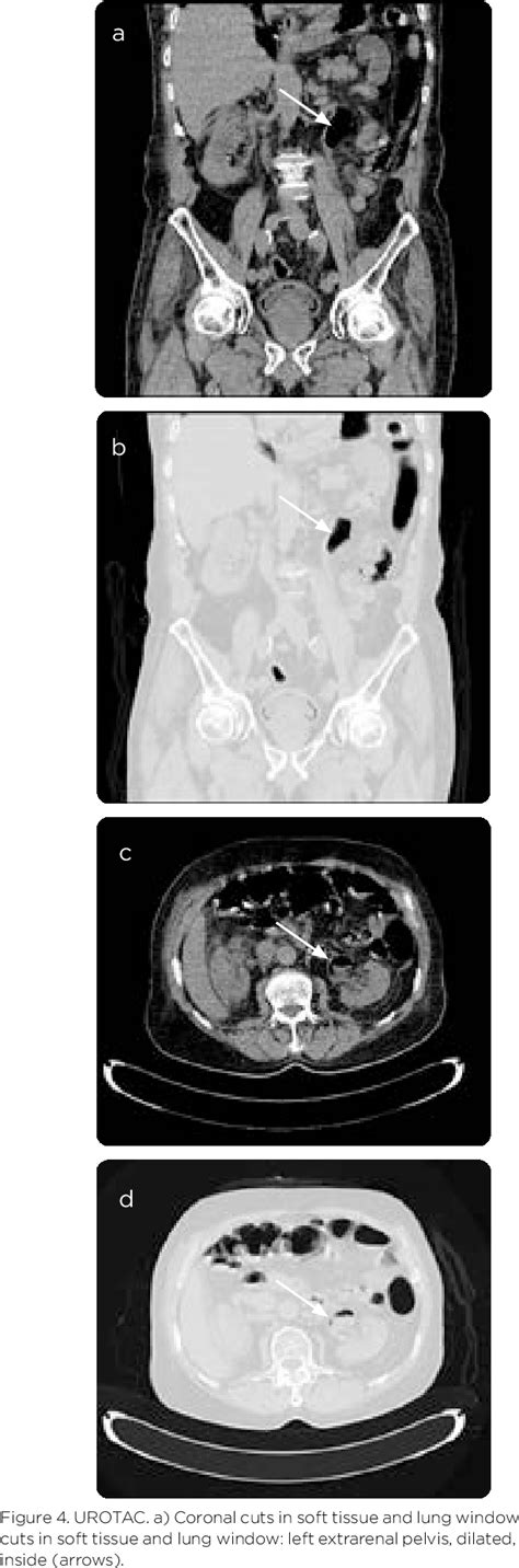 [pdf] Emphysematous Cystitis And Pyelonephritis In A Non Diabetic Patient Case Report
