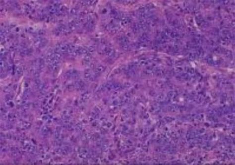novus biologicals™ human breast tissue microarray cancer human breast