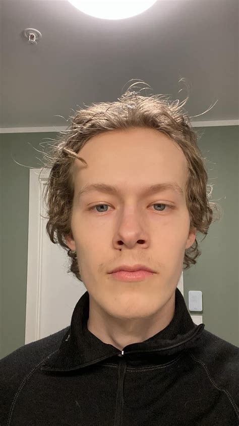 Premolar Extraction Retraction Victim What Should I Do R Jawsurgery