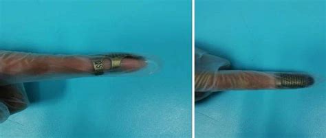 跟针刺伤说拜拜：护士借助小 神器”有效预防针刺伤护理