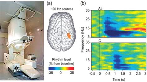 A Magnetoencephalography Image In The Contralateral Primary Motor Download Scientific Diagram