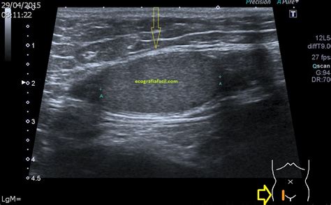 214 Lesiones Testiculares Ecografía Fácil