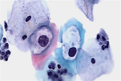 Thinprep® Preservcyt® Collection Vials Hologic® Australia